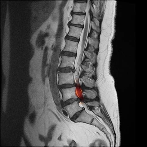 Stenosi Del Canale Vertebrale Sicvandgis