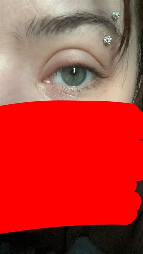 Is This Blepharitis Or A Stye I Am Scared R Blepharitis