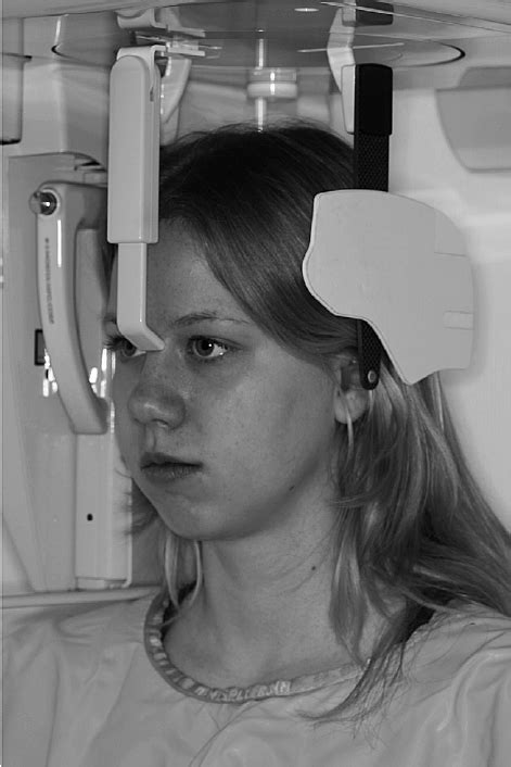 Patient In Cephalostat With Anatomically Shaped Cranial Collimator