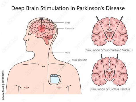 Deep Brain Stimulation Structure Parkinson Disease Diagram Hand Drawn