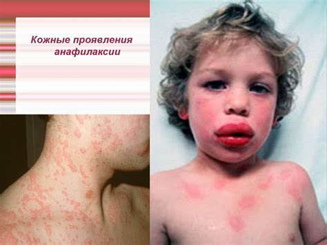 Анафилактический шок презентация онлайн