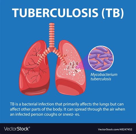 Human Anatomy Of Lung With Tuberculosis Royalty Free Vector