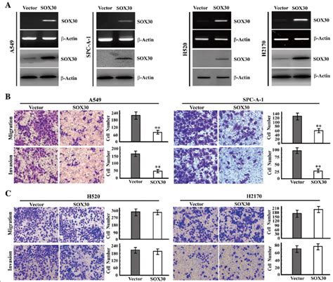 Sox30 Inhibits Cancer Cell Migration And Invasion In Adc Cell Lines But