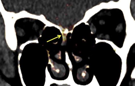 Dual Energy Ct Cisternography In The Evaluation Of Csf Leaks A Novel Approach Pmc
