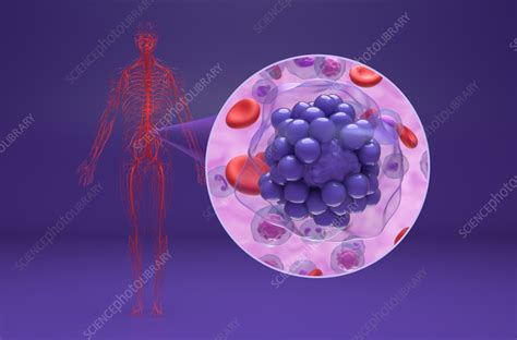 Diffuse Large B Cell Lymphoma Illustration Stock Image F043 8320