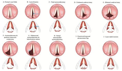 Jerome R Lechien Md Phd Ms Facs On Linkedin How To Treat Posterior Glottic Stenosis