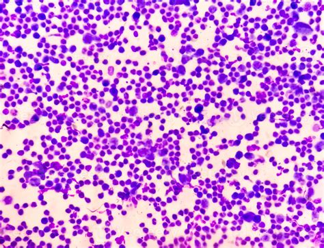 Synovial Fluid Cytology Plenty Wbc Microscopic Examination Of