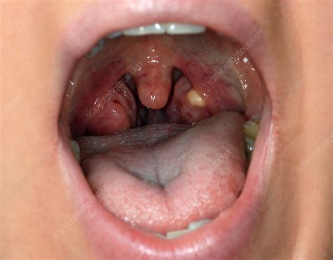 Tonsil Cyst Stock Image C0181018 Science Photo Library