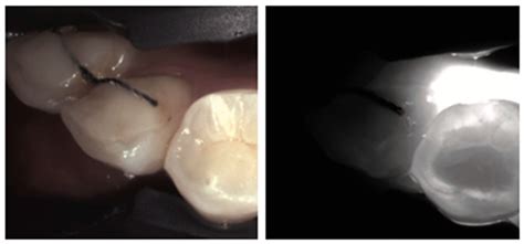 Atlas Of Dental Near Infrared Transillumination Images