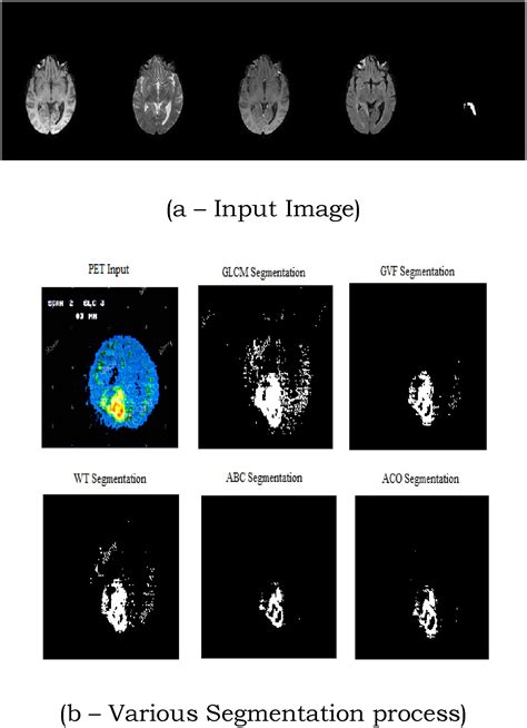Multi Class Robust Brain Tumor With Hybrid Classification Using Dta