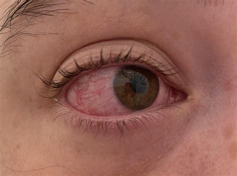 I Was Diagnosed With Episcleritis R Episcleritis