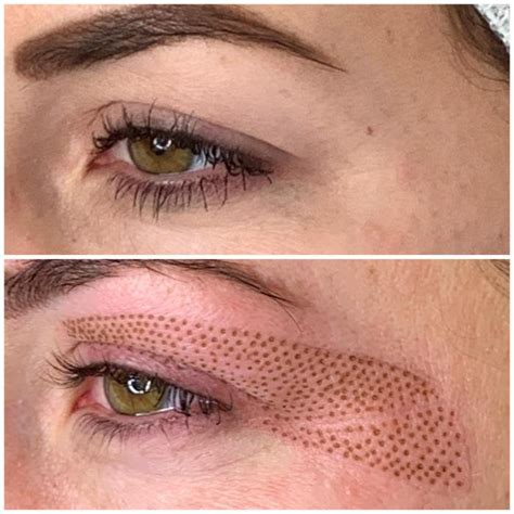 Blépharoplastie Médicale Plexr à Caen I Dr Romuald Sheykhan