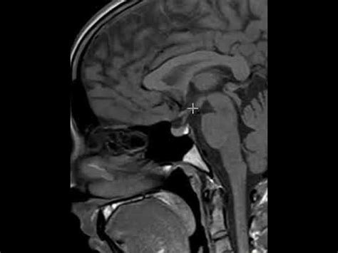 Pituitary Tumor Mri