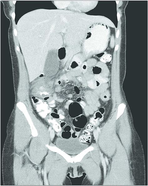 Acute Right Upper Quadrant Diverticulitis An Unusual Sonographic