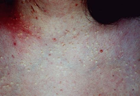 About Steatocystoma Multiplex Hxrbf