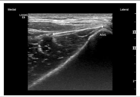 Anterior Superior Iliac Spine Compression Test Semantic Scholar