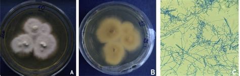 Drug Resistant Trichophyton Indotineae In India I Upsc