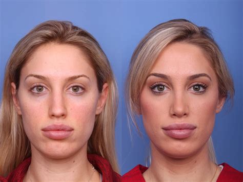 Nose Job Surgery Procedure