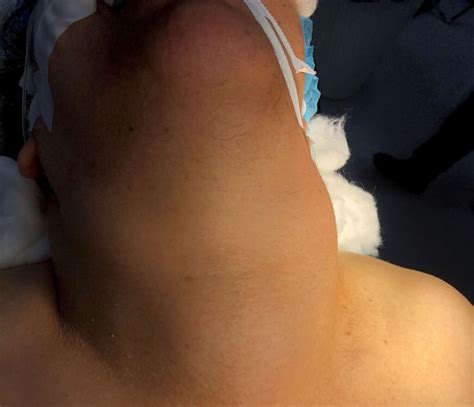 Large Toxic Multinodular Goiter Total Thyroidectomy Jun 2021 Dr Raad Al Saffar