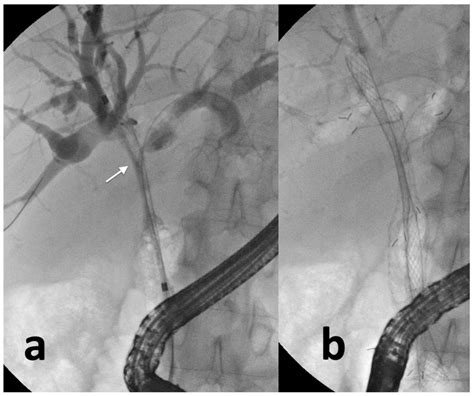 Complex Hilar Biliary Stricture Arrow In A Patient With Gallbladder Download Scientific