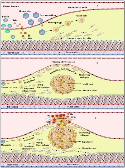 Initiation Of Atherosclerosis A Progression B And Rupture Of