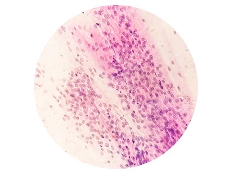 Premium Photo Trichomonas Vaginalis In Pap Smear With Few Acute Inflammatory Cells