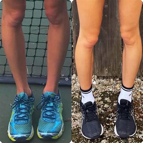 Miserable Malalignment Syndrome Miles4hips