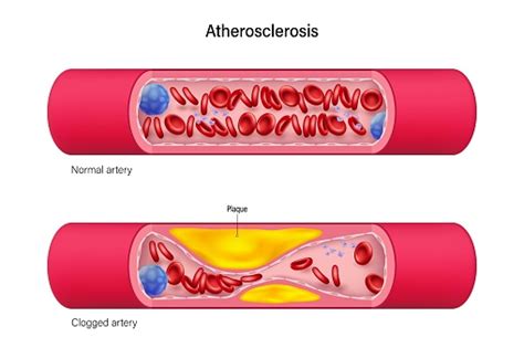 Ilustración De Arteria Normal Y Vector De Arteria Obstruida Enfermedad
