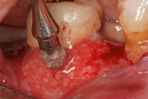 The Perio Surgery Formula