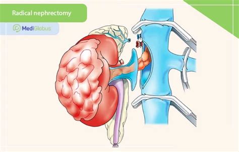 How To Treat Clear Cell Sarcoma Mediglobus