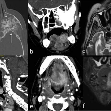 Pdf Radiation Induced Maxillary Osteosarcoma And Synchronous Oropharyngeal Squamous Cell