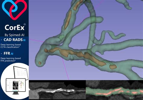 Spimed Ai On Linkedin Intelligenceartificielle Spimed Ai