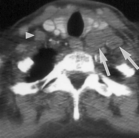 Unilateral Supraclavicular Mass In A Division I Male