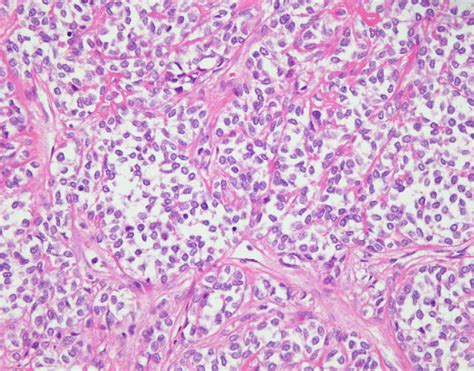 More Advanced Pattern Of Stromal Hyalinization Shows Thin Fibrous Bands