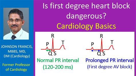 First Degree Av Block