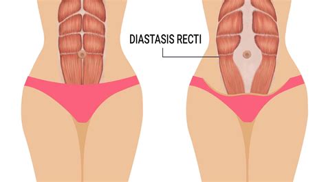 The Abcs Of Fixing Diastasis Recti The Belle Method