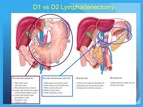 Gastric Cancer