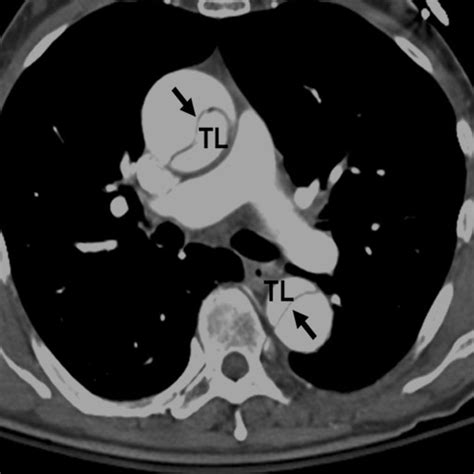 Acute Aortic Dissection Rcemlearning India
