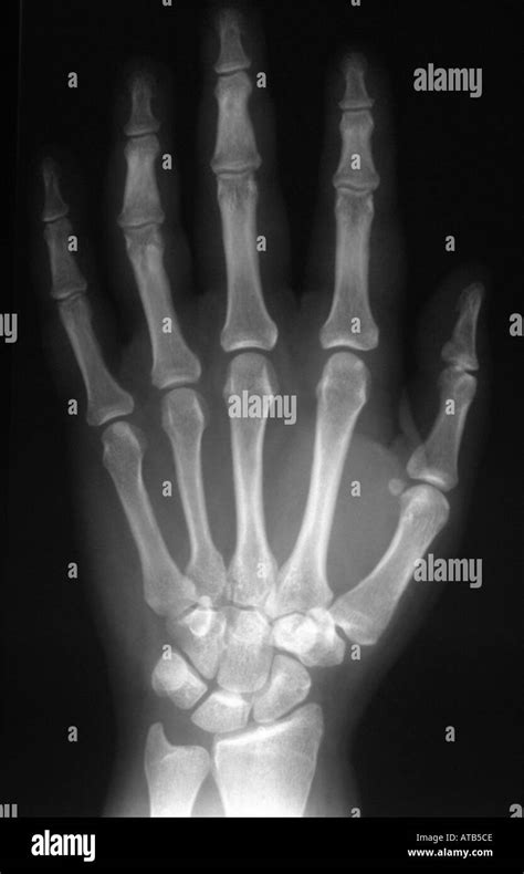 Normal Hand X Rays At Edgar Portis Blog