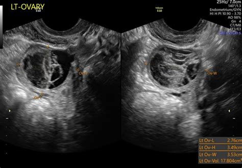 Retained Products Of Conception Rpoc Sonosession