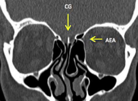 49 Endoscopic Ethmoidectomy Fess Surgical Technique Medicine