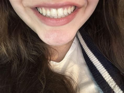 Got My Braces Off Today Thoughts Rbraces