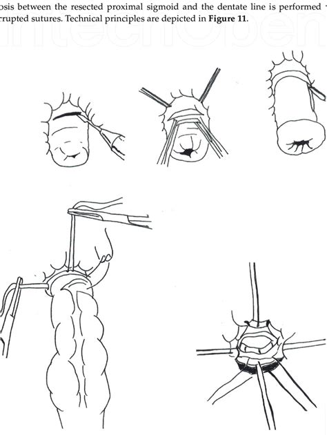 The Altemeier Procedure Depicted Through The Main Stages Download