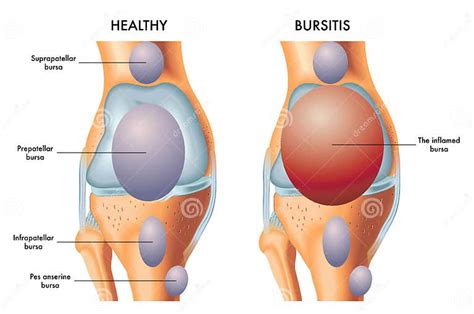 Prepatellar Bursitis Stock Vector Illustration Of Drawing 146823718