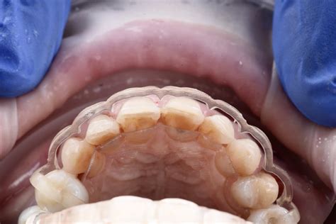 Delivering Precision With Predictability Why Guided Dentistry And 3d