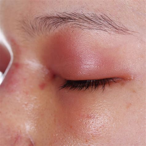 Five Early Warning Signs You May Have An Autoimmune Skin Disease Tash360
