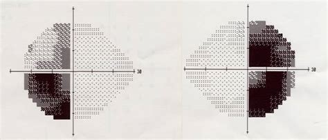 Prolactinoma And Visual Field Deficits Pituitary World News