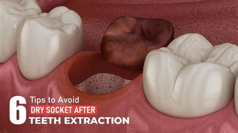 6 Tips To Avoid Dry Socket After Teeth Extraction Dental Blog