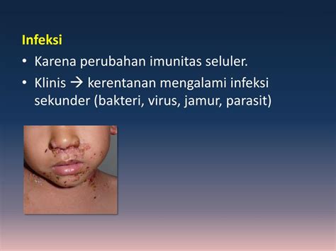 Ppt Dermatitis Atopik Powerpoint Presentation Free Download Id2862671