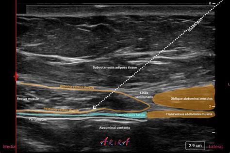 Rectus Sheath Block